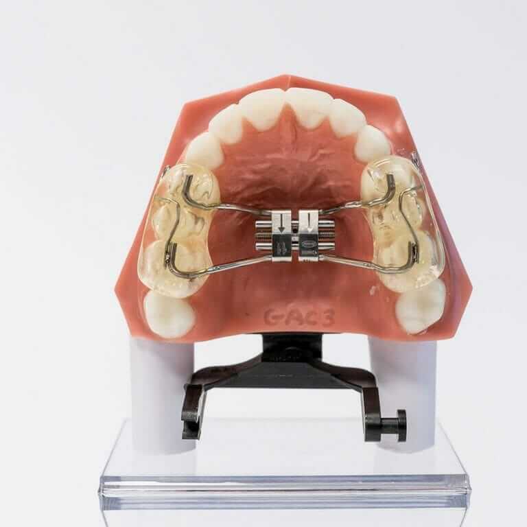 Banded and Bonded Expanders - Appliances for Widening the Upper Jaw