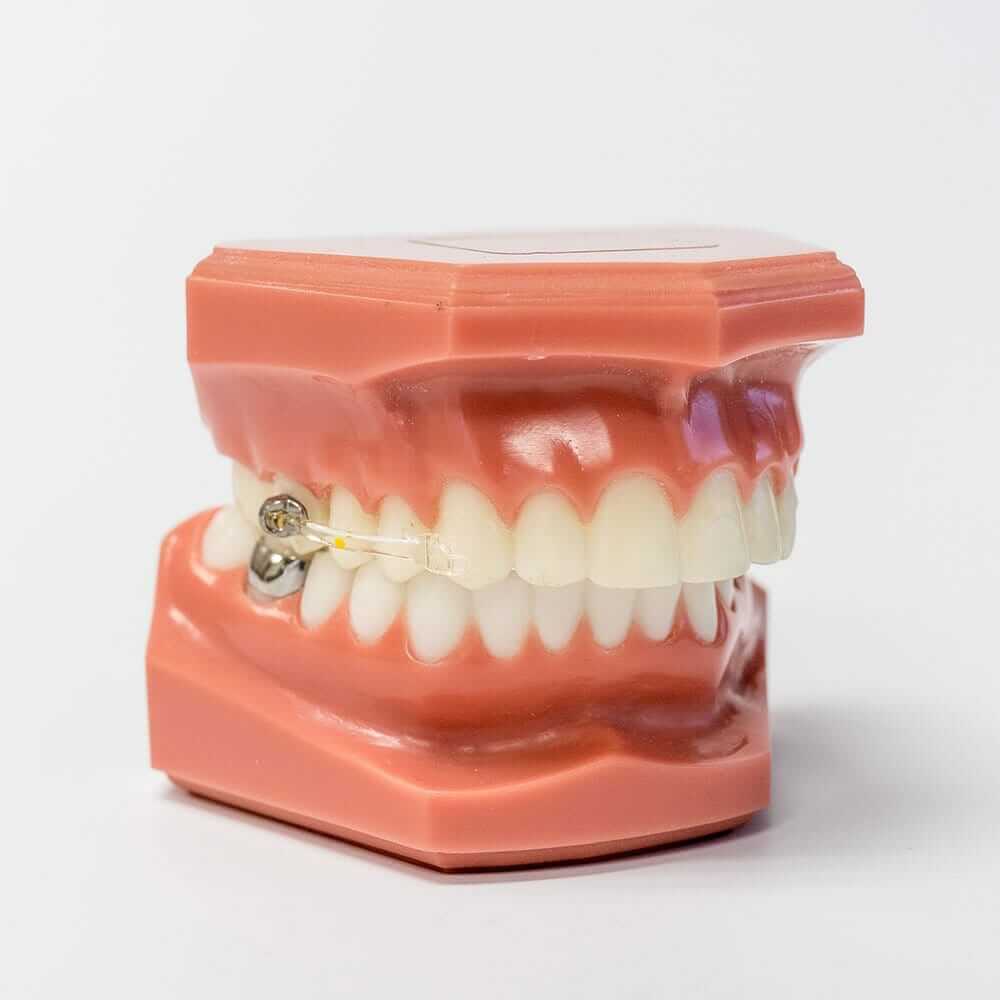 Dental Midline, Midline Discrepancy, and Misplaced Midline