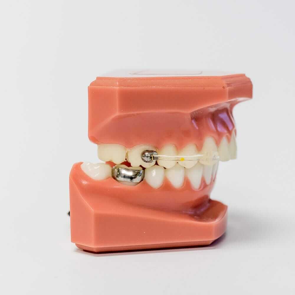 Proclined and Retroclined Teeth: Causes and Treatments