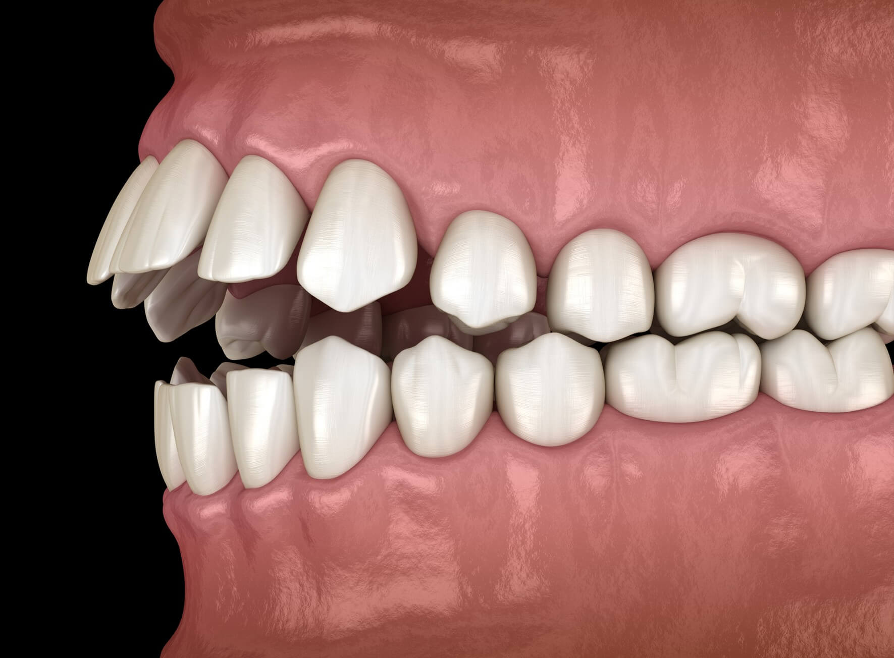 Managing Vertical Dimension in Orthodontics