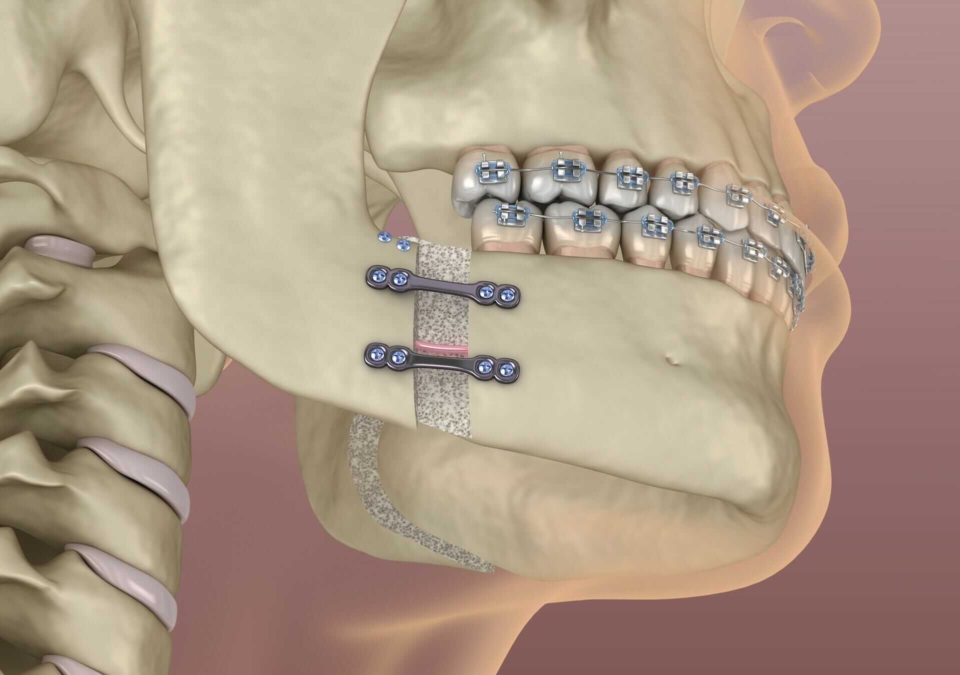 Bilateral Sagittal Split Osteotomy (BSSO) Surgery
