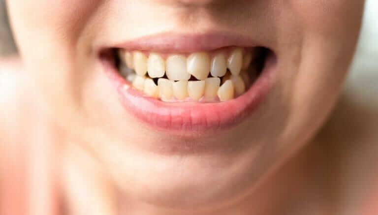 Underbite vs. Overbite - Understanding Malocclusions and Treatment