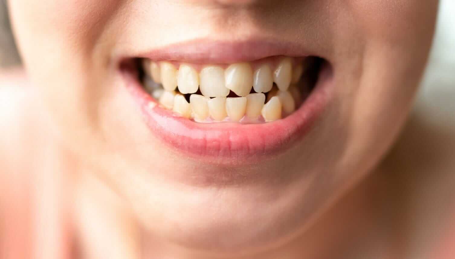 Underbite vs. Overbite - Understanding Malocclusions and Treatment