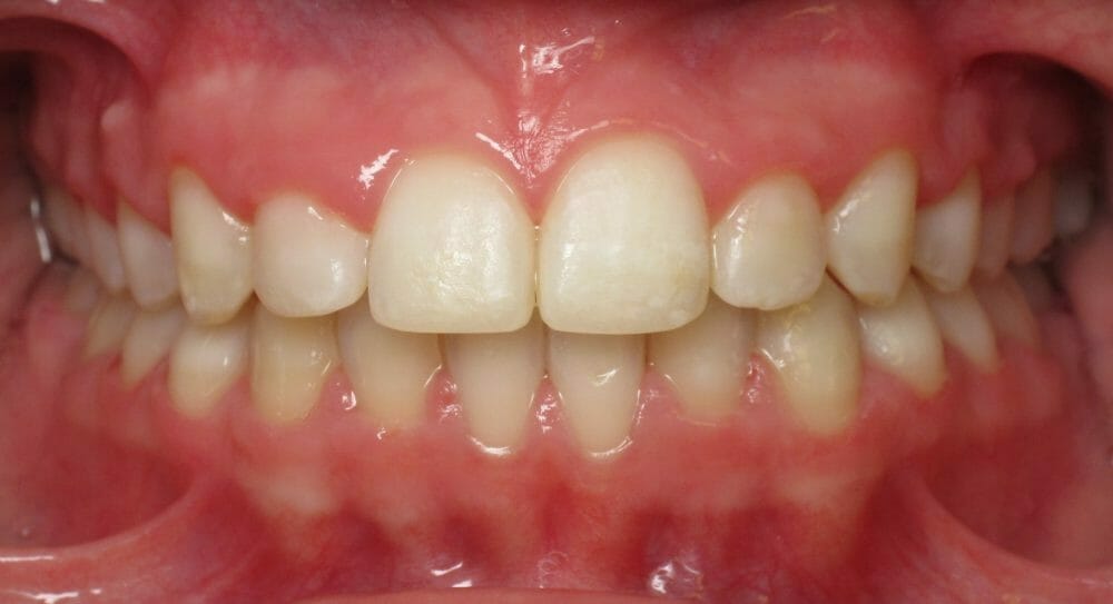 Quad Helix Appliance