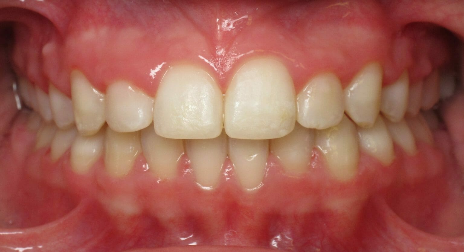 Quad Helix Appliance