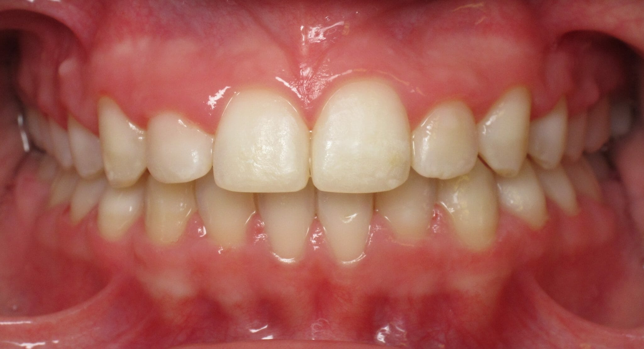 Quad Helix Appliance