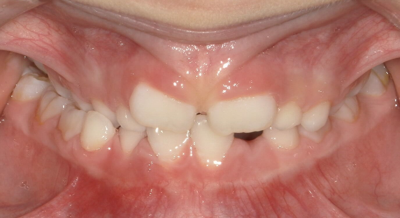 Quad Helix Appliance