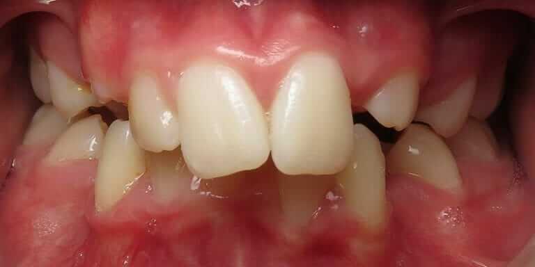 Crowded Teeth Orthodontic Treatment Options