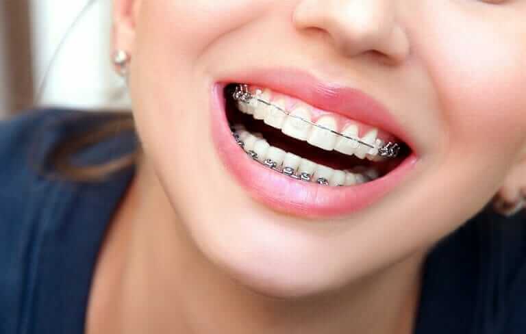 Damon System Bracelift - Burke & Redford Orthodontists