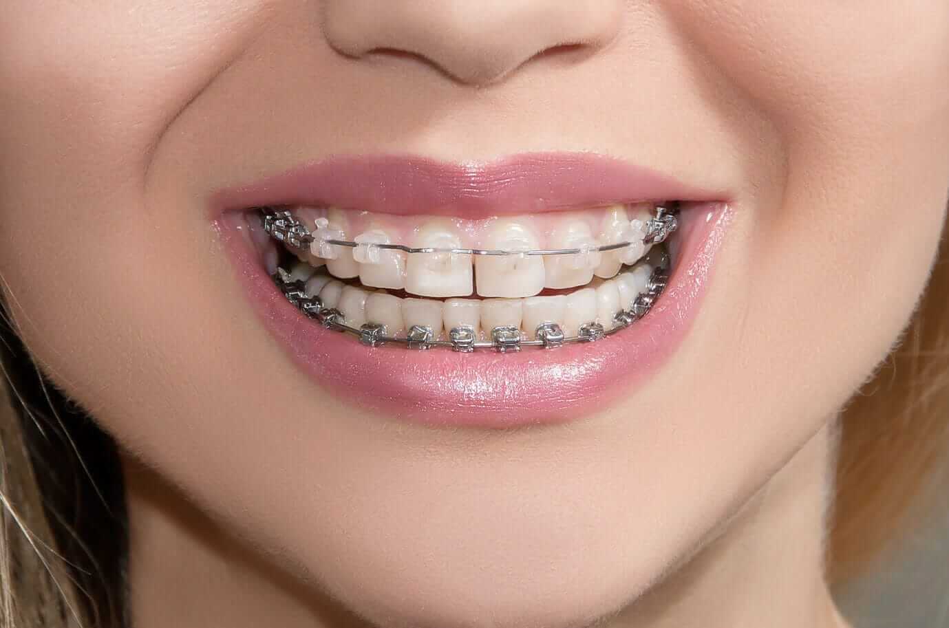 Proclined and Retroclined Teeth: Causes and Treatments