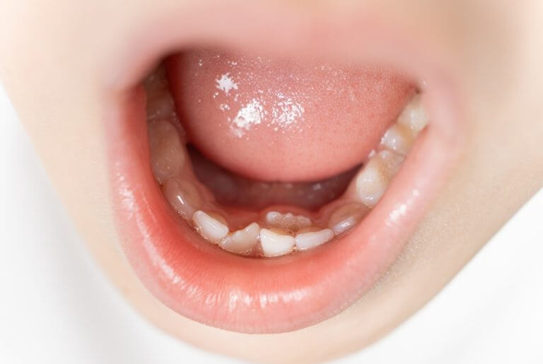 Lingual Eruption of Teeth - Burke & Redford Orthodontists