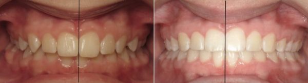 Dental Midline, Midline Discrepancy, and Misplaced Midline