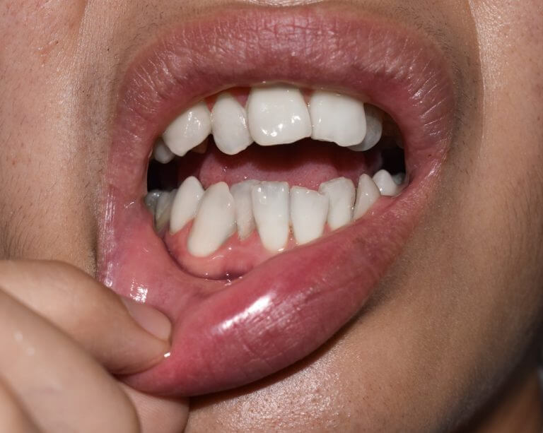 Ectopic Eruption of Teeth