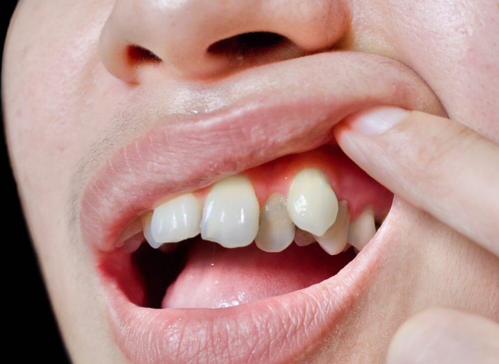 Supernumerary Teeth - Hyperdontia Treatment