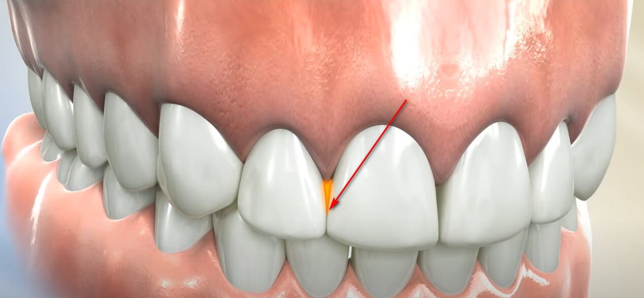 Interproximal Reduction (IPR) in Orthodontics