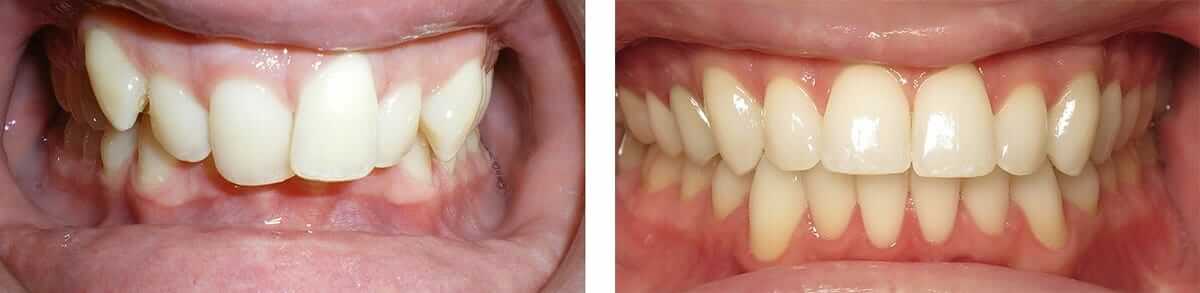 Orthognathic Surgery - Jaw Surgery - Orthodontists Work w/ OMS Surgeon