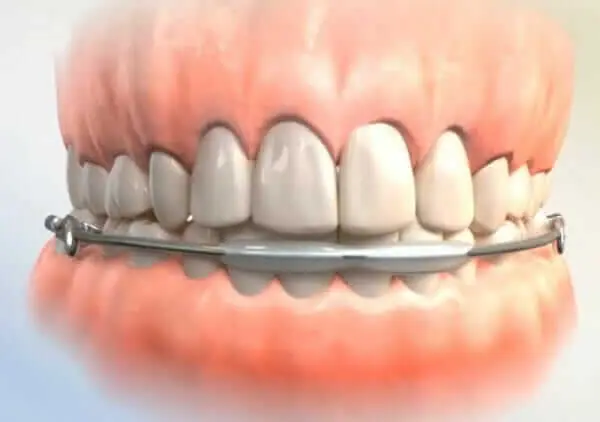 Orthodontic Lip Bumper Creates Space for Your Teeth