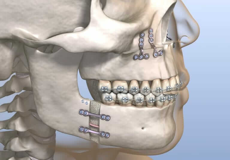Bilateral Sagittal Split Osteotomy (BSSO) Surgery