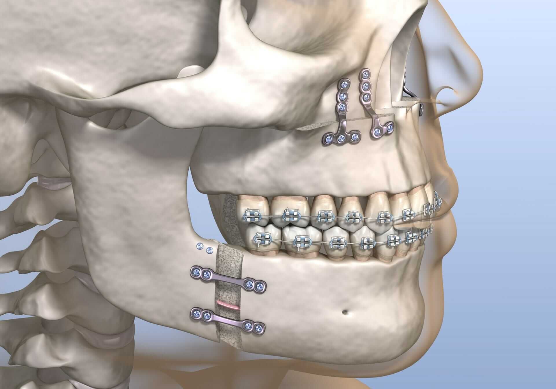 Bilateral Sagittal Split Osteotomy (BSSO) Surgery