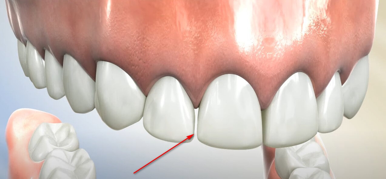 Interproximal Reduction (IPR) in Orthodontics
