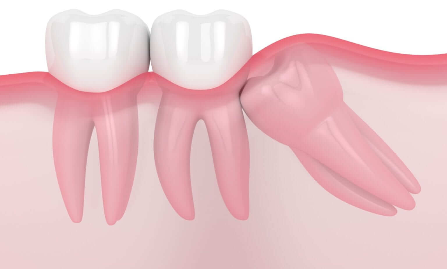 Overeruption is the Absence of an Opposing Tooth