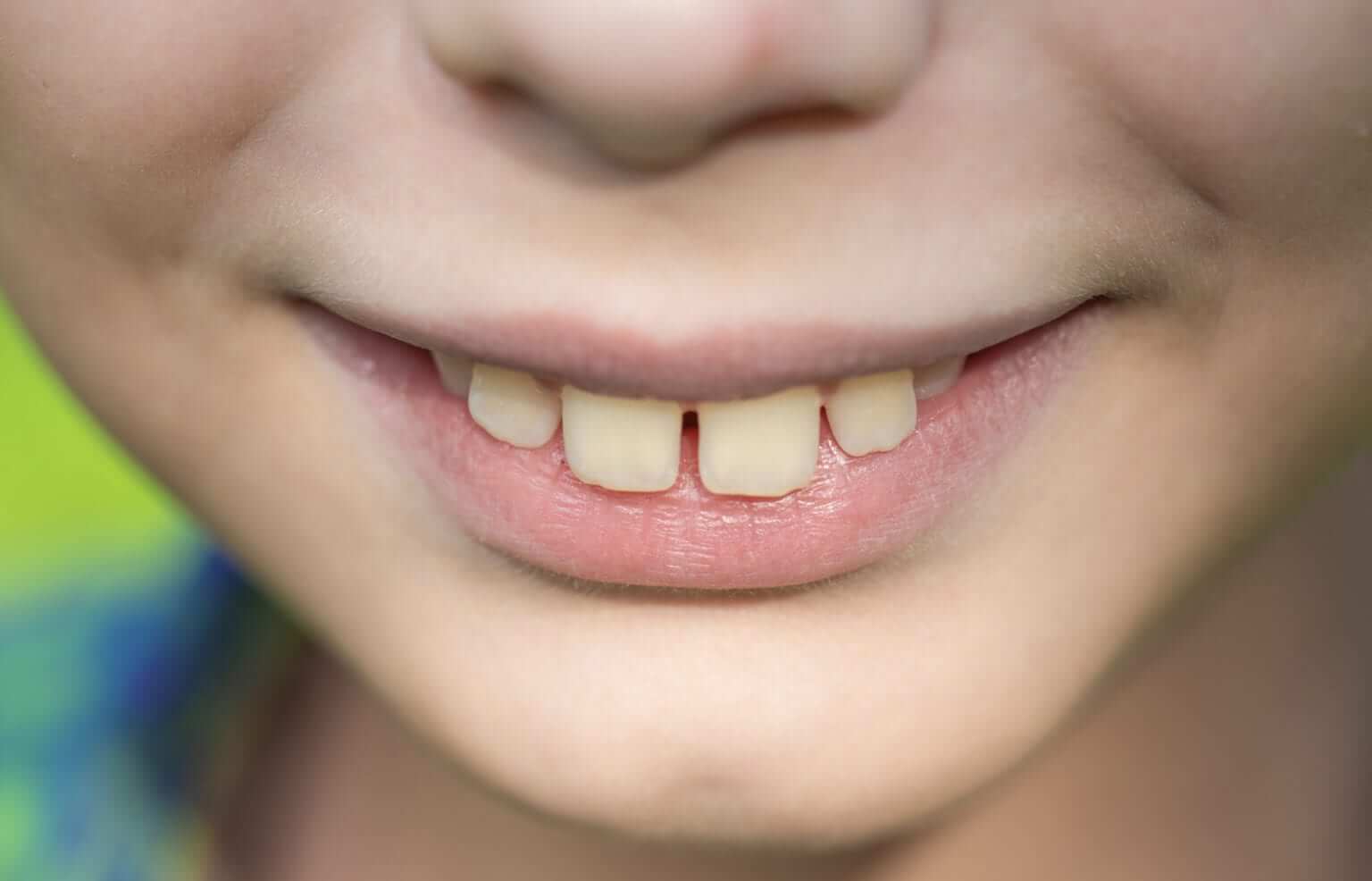 How Do Teeth Move? How Fast Do Teeth Move with Braces? Find Out...