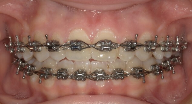 Dental Midline, Midline Discrepancy, and Misplaced Midline