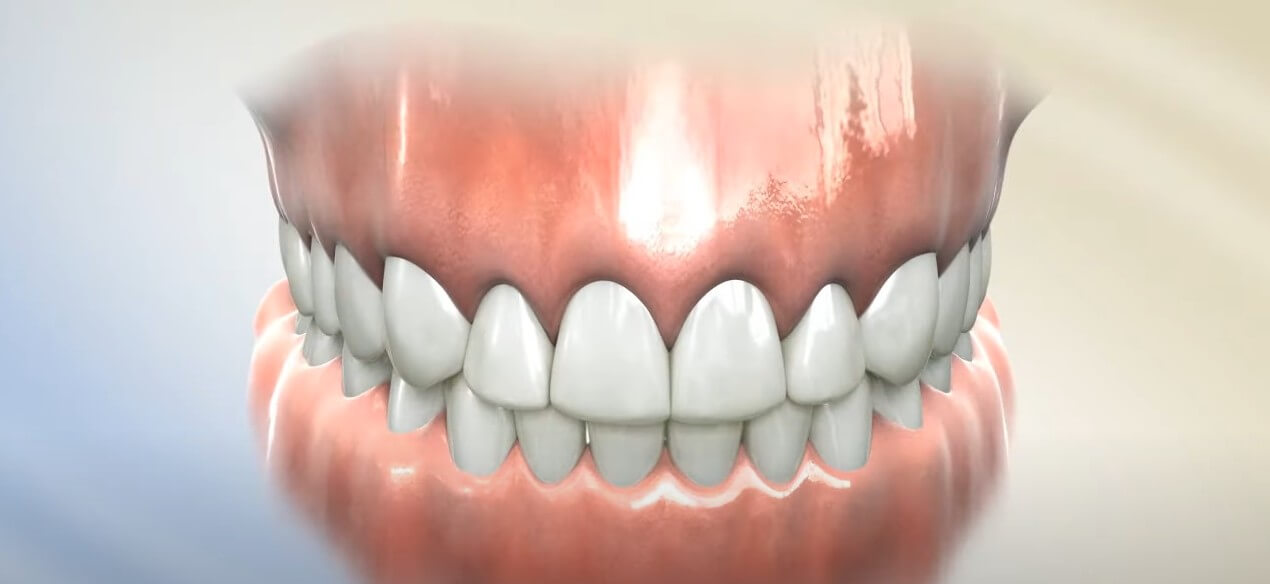 Interproximal Reduction (IPR) in Orthodontics