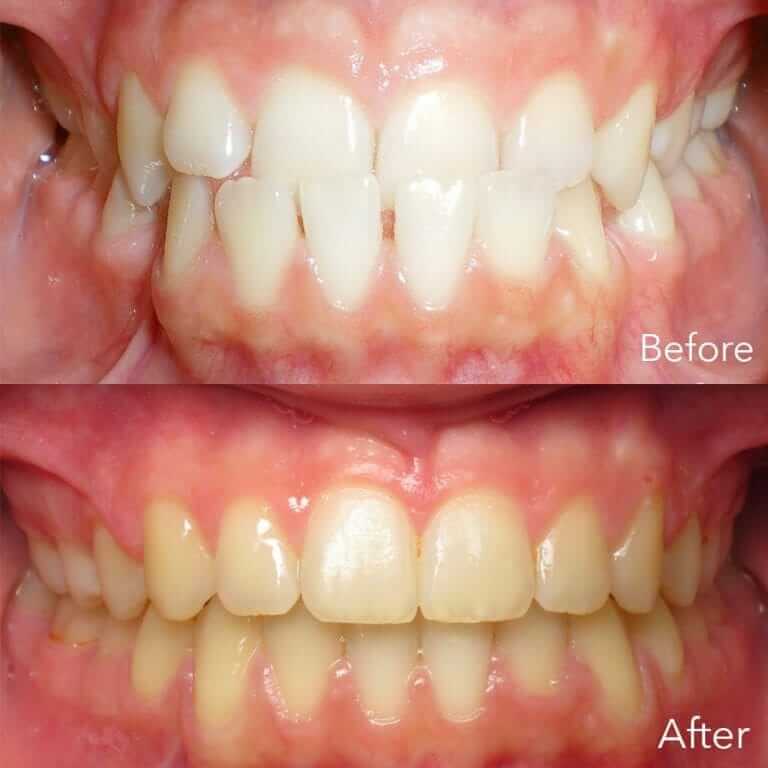 Common Orthodontic Problems - Overbite, Underbite, Crowding, Gap, Etc.