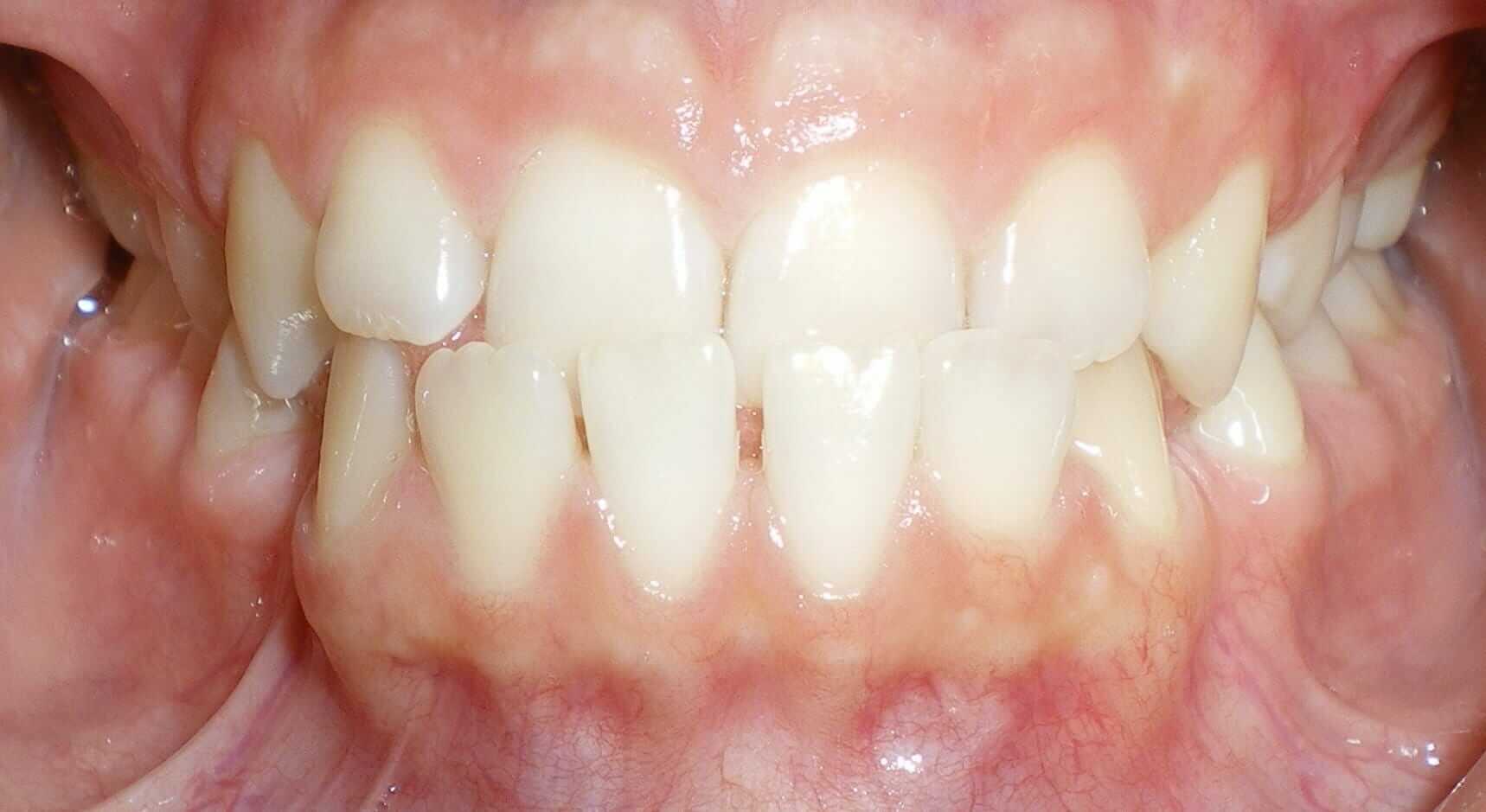 Signs You May Need Braces